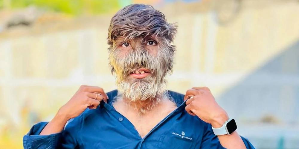 Joven con extraña condición gana Récord Guinness por la mayor densidad de vello facial