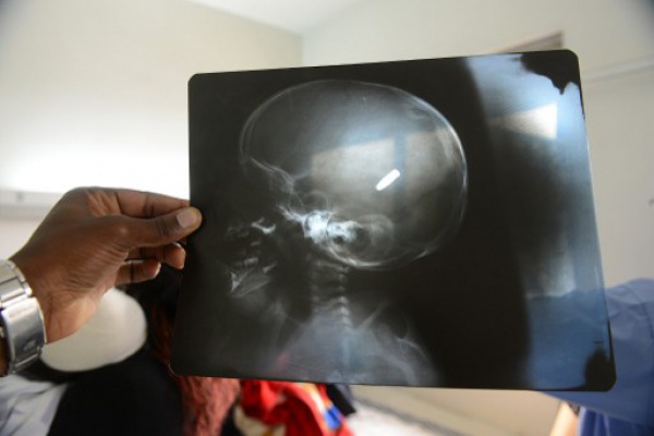 Hombre se clava un palo de 15 cm en el ojo y llegó hasta el cerebro Hombre se clava un palo de 15 cm en el ojo y llegó hasta el cerebro